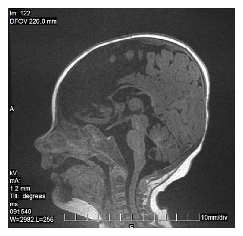 Fspgr Sequence 3d T1wi Sagittal Plane Callosal Hypoplasia In The