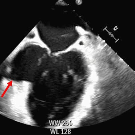 Left Ventricle Aneurysm With Dilated Left Ventricle Left Ventricle