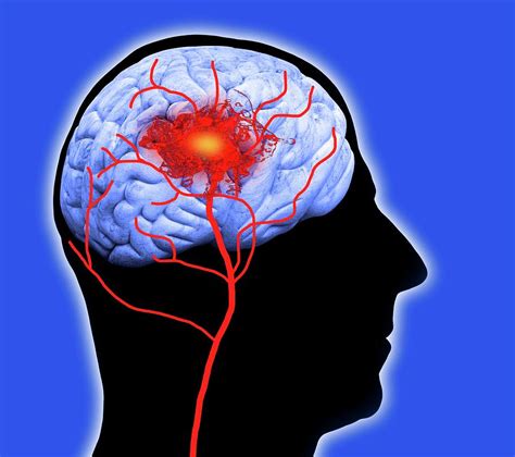 Do Brain Cells Die After A Stroke At Daryl Pulver Blog