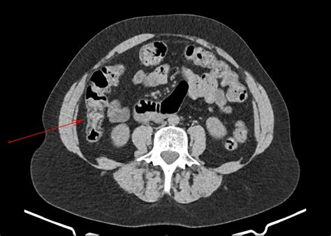 Prevalence And Clinical Significance Of The Gastrointestinal Fat Halo