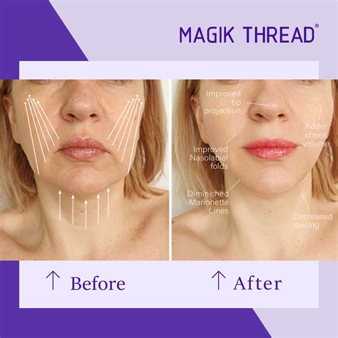 Before And After Pdo Thread Lift Abdomen Dermax