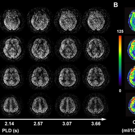 diagram of cerebral perfusion by multi delay asl mr imaging a the