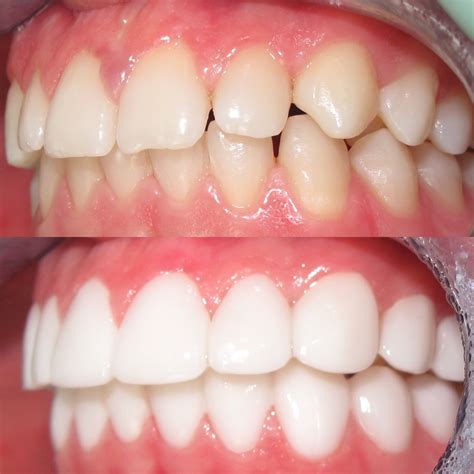 Pin Di Cassandra 74 Su Teeth Nel 2024 Denti