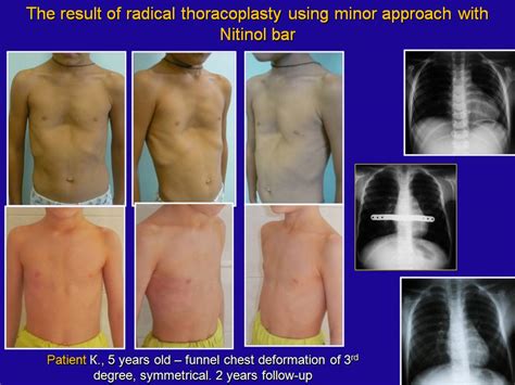 Funnel Chest In At Johnny Will Blog