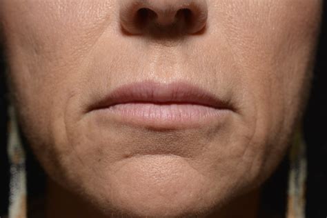 Filler Injection Genesis Plastic Surgery And Medical Spa