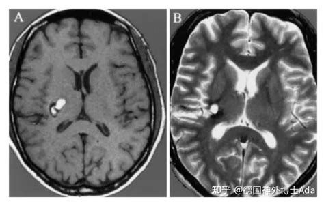 基底节区精细解剖图来了！能做手术吗？ 知乎