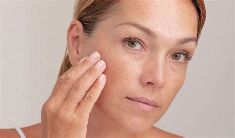 Different Types Of Pigmentation And How To Treat Pigmentation