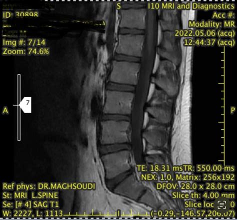My Recovery Story Disc Herniation L5s1 L4l5 And Ddd L3l4 Rsciatica