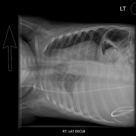 Pdf Beta 2 Transferrin To Detect Cerebrospinal Fluid Pleural Effusion