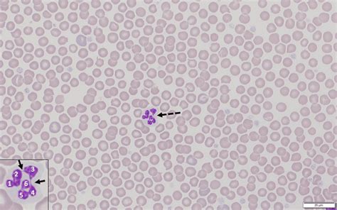 Top 5 Leukogram Patterns Associated With Abnormal Neutrophil Concentrations