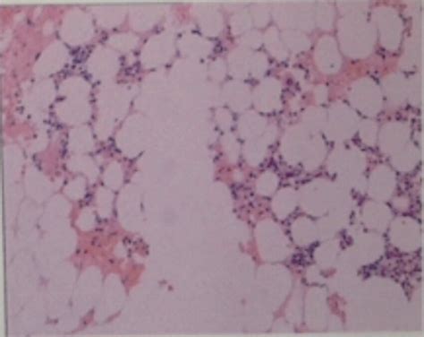 Bone Marrow Biopsy Shows Plasmacytosis Download Scientific Diagram