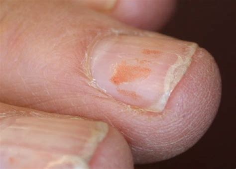 👉 Onychorrhexis Causes Pictures Symptoms Treatment January 2022