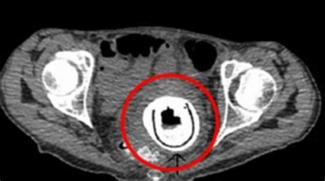 Alat Bantu Seks Nyangkut Tahun Di Kelamin Perempuan