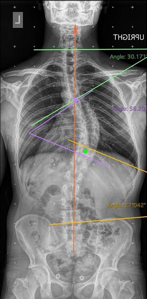 29m 56°~ Curve Thoracic 30°~ Compensatory Lumbar Curve Rscoliosis 29m 56°~ Curve Thoracic 30°~ Compensatory Lumbar Curve Rscoliosis
