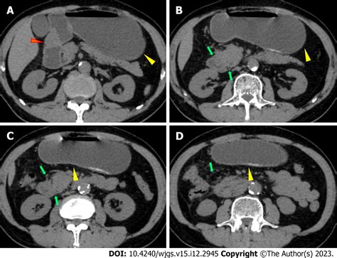 Duodenojejunostomy Bypass Cpt