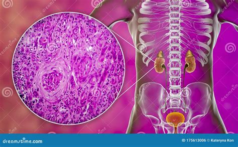 Chronic Glomerulonephritis Gross Pathology Stock Illustration Illustration Of Cell