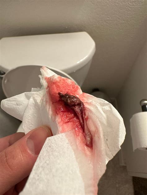 Natural Miscarriage At 7 Weeks