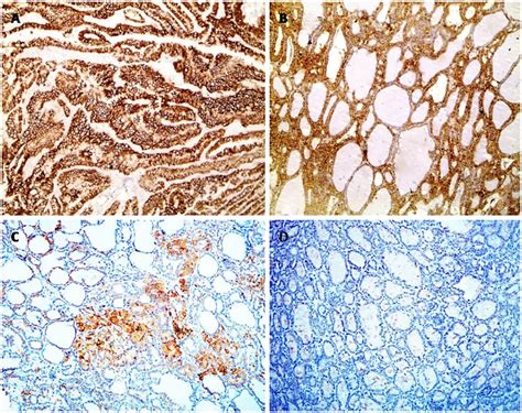 Positive And Diffuse Trop 2 Membranous Expression In A Case Of Classic