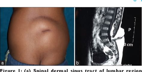 Dermal Sinus Tract