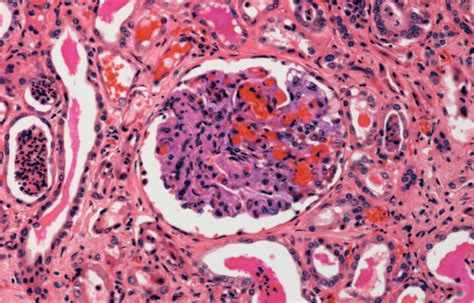 Difference Between Necrosis And Infarction Difference Between Necrosis Vs Infarction