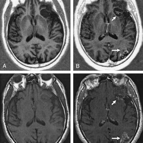 Axial Images Obtained In A Patient With Multiple Cerebral Abscesses A