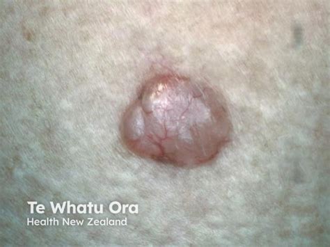 Nodular Basal Cell Carcinoma Images