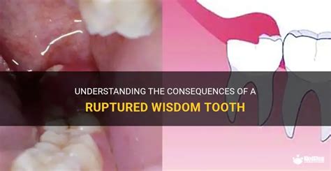 Understanding The Consequences Of A Ruptured Wisdom Tooth Medshun