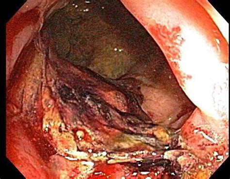 Proctitis Alchetron The Free Social Encyclopedia