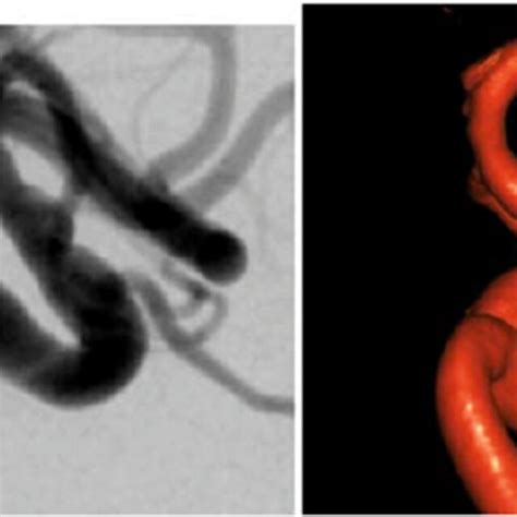 Internal Carotid Blister Aneurysm Download Scientific Diagram