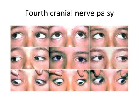 Ppt Neuro Ophthalmology Powerpoint Presentation Free Download Id