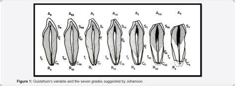 Open Access Journal Of Surgery Oajs Juniper Publishers