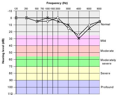Nihl Audiogram
