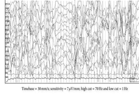 Abnormal Eeg Patterns Pptx Brain And Nervous System Disorders