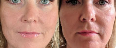 Can You Inject Exosomes Under Eyes