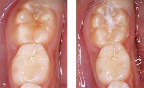 Fissure Sealants Peninsula Gateway Dental Frankston