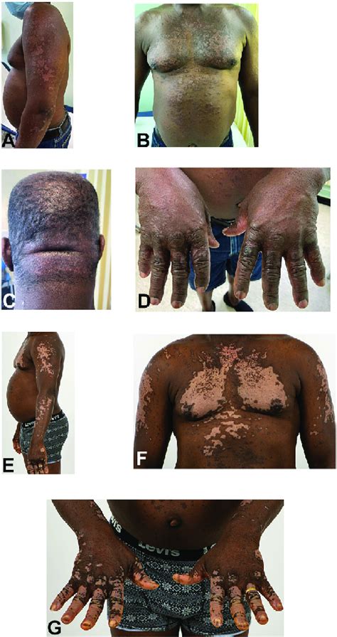 Widespread Polycyclic Annular Lesions On The Arms Trunk Scalp And