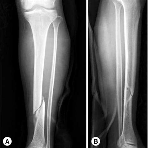 Pdf Anatomically Percutaneous Wiring Reduction In Minimally Invasive Plate Osteosynthesis For