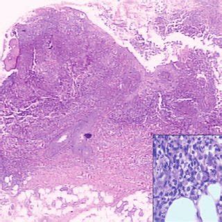 Superficial Diffuse Dermatitis With An Inflammatory Process At Base Download Scientific