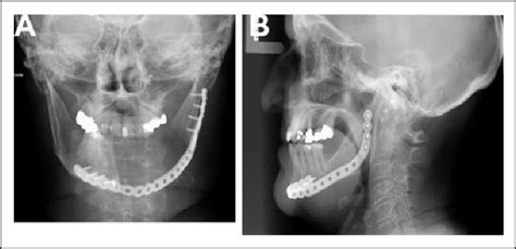 Good Restoration Of Contour With A Locking Prefabricatedbent Plate And