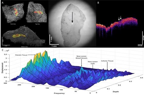 Three Dimensional Color Coded OCT Images A Of A Superficial Basal Download Scientific Diagram