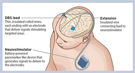 Deep Brain Stimulation Dbs Programming Ahmedabad Dr Narendra Barad