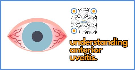 Understanding Anterior Uveitis Causes Symptoms And Treatment Options