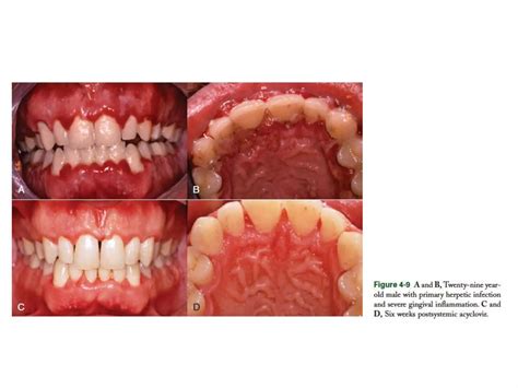 Gingivitis Classification Ppt