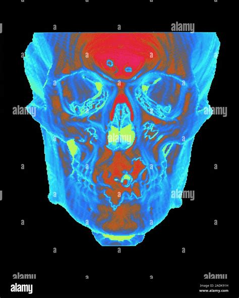 Human Skull Coloured Computed Tomography Ct Scan At Top Is The