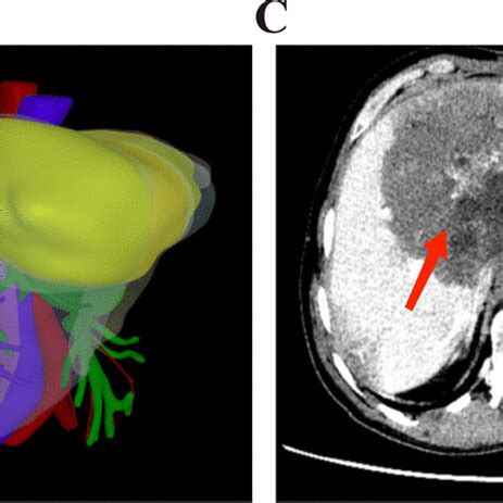 After TSH Procedures TSH Patient With FLRV TLV Was Able To Download Scientific