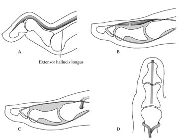 Correction Of Clawed Hallux Deformity Comparison Of The Jones