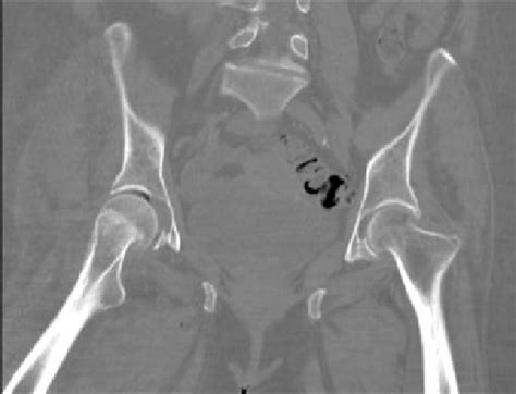 Coronal View Of A CT Reported As An Intracapsular Neck Of Femur Fracture Download Scientific