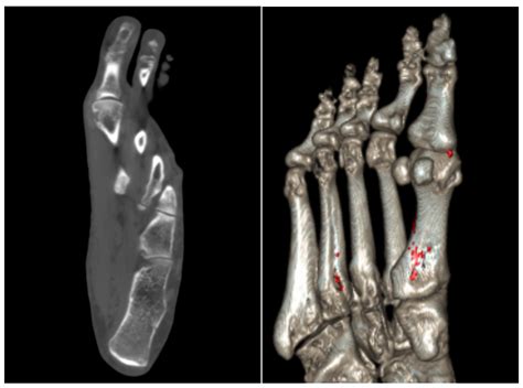 Diagnostics Free Full Text Updates On The Applications Of Spectral Computed Tomography For