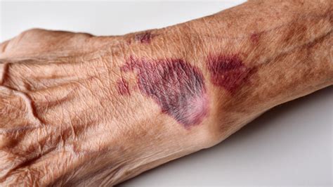 What Causes Bruising In The Elderly