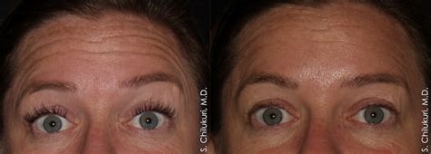 Neuromodulators 18 Refresh Dermatology